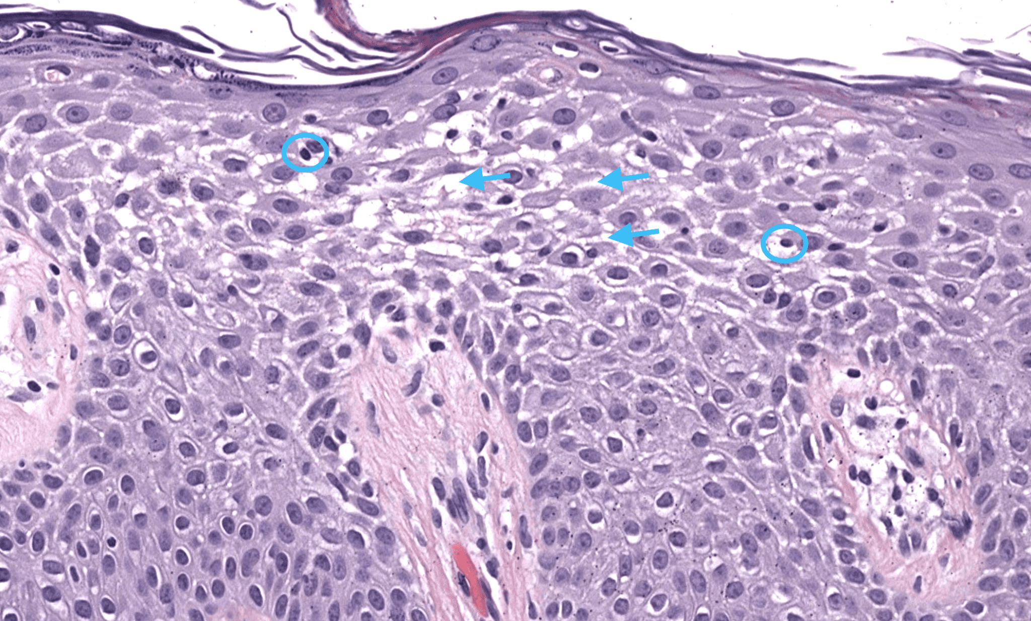 Dermatitis atópica Costa Rica | Síntomas, Causas y Tratamientos