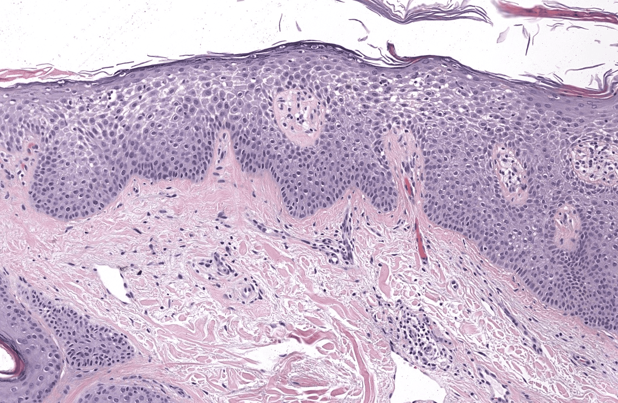Dermatitis atópica Costa Rica | Síntomas, Causas y Tratamientos