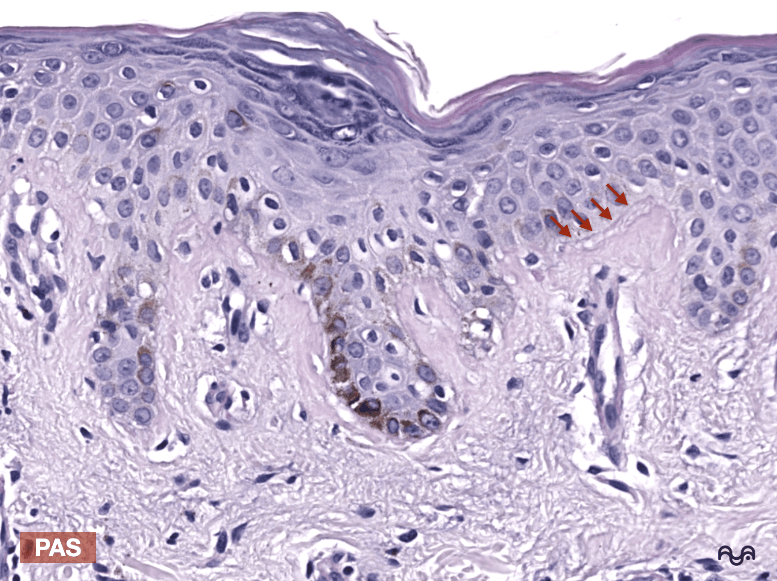 Histology of normal skin (module 5): The dermoepidermal junction